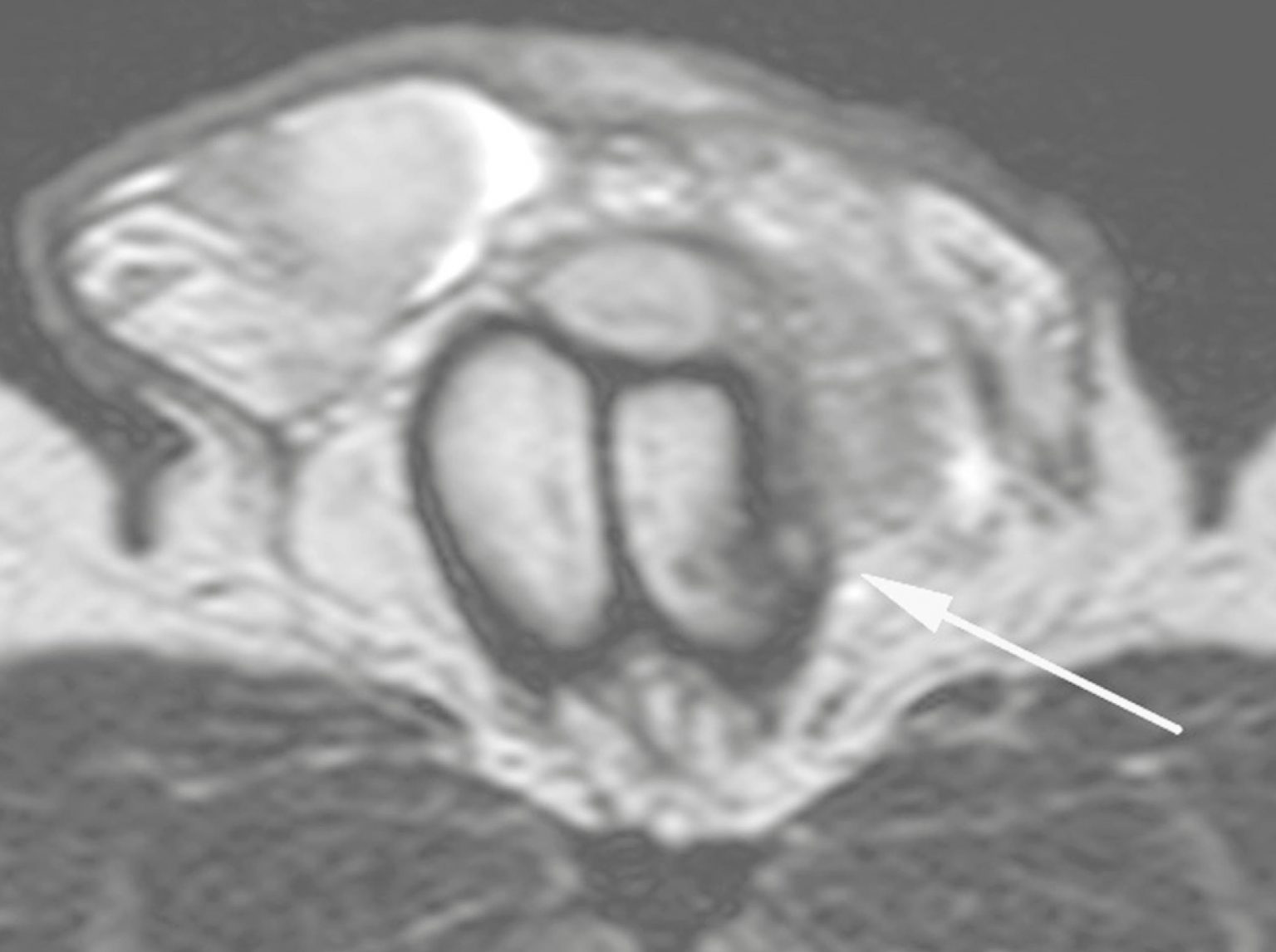 Penile fracture